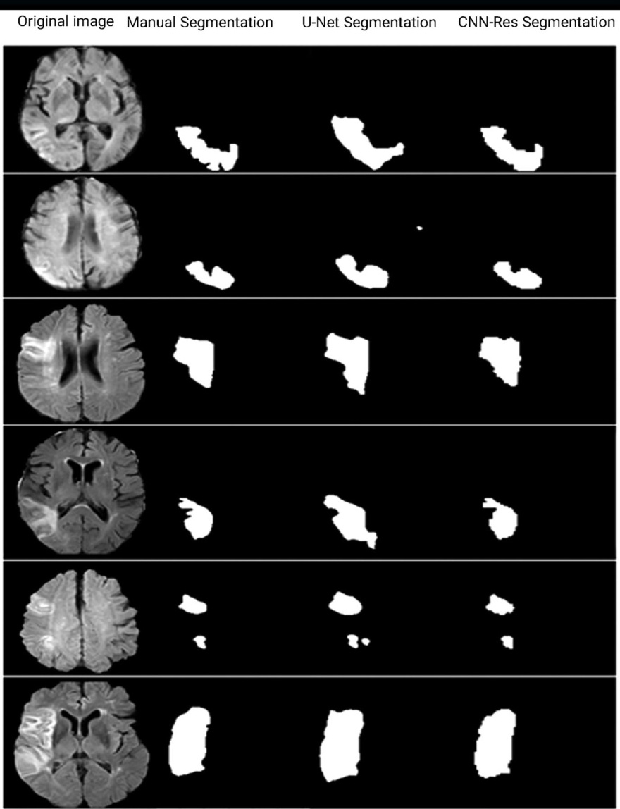 关于U-Net在脑部MRI图像分割中的应用的问题_u-net meningioma mri-CSDN博客