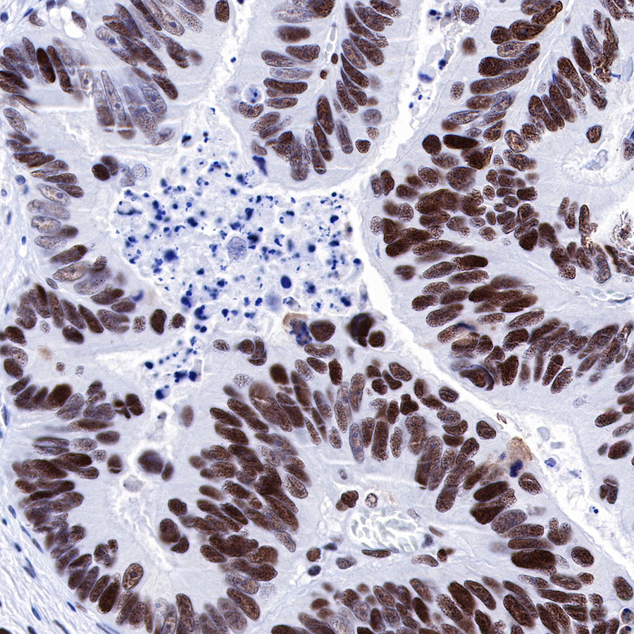 IHC Cancer Biomarker | MMR Protein Immunohistochemistry: Key Biomarker ...