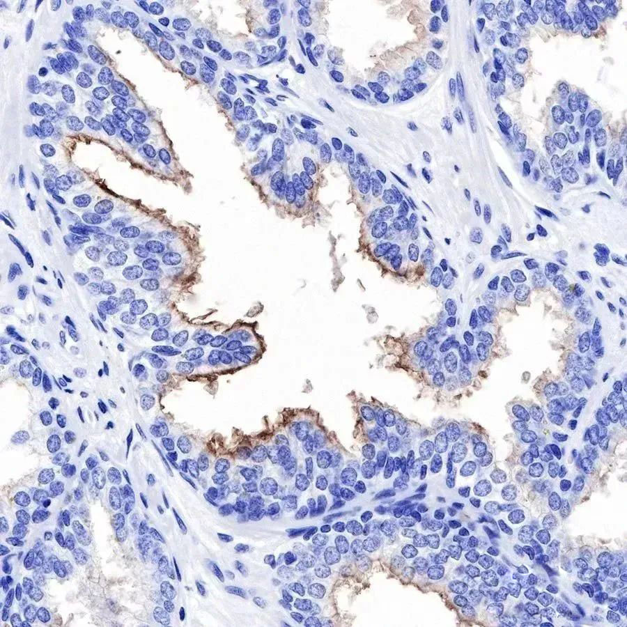 IHC肿瘤标志物 | 常见前列腺癌诊断_病理报告ihc psa-CSDN博客