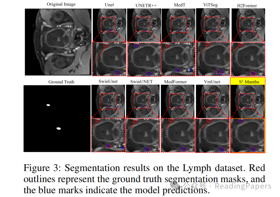 医图伦文 AAAI‘25 | S³-Mamba：面向病灶分割的小尺寸敏感Mamba模型_s鲁-mamba: small-size-sensitive mamba for lesion se ...