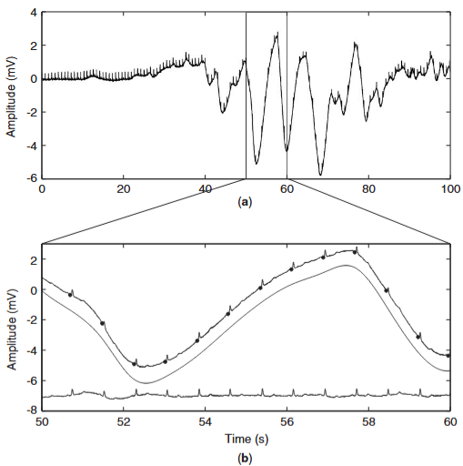 心电（ECG）信号处理流程与算法详解（一）_ecg adc采集之后如何实现基线消除-CSDN博客