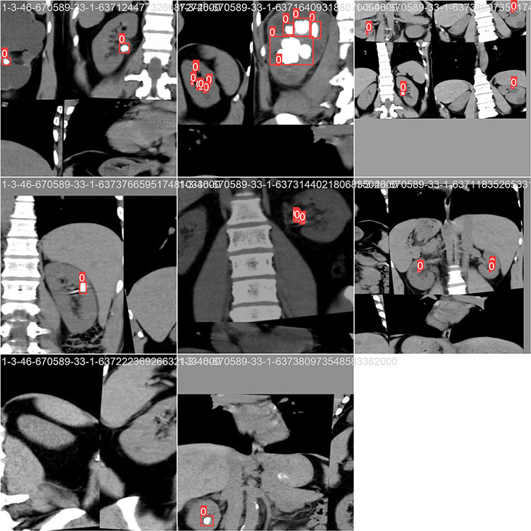 基于YOLOv10深度学习的医学影像CT图像肾结石检测系统研究与实现(PyQt5界面+数据集+训练代码)_深度学习结石自动诊断系统-CSDN博客
