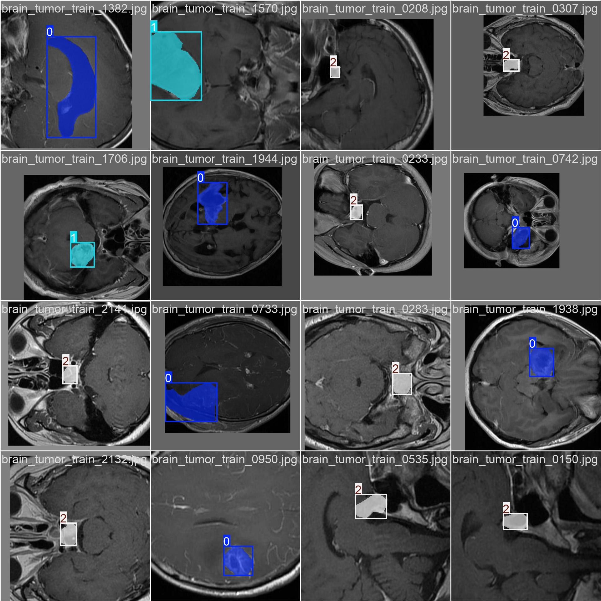分割数据集 - 大脑肿瘤MRI分割数据集下载_脑卒中分割数据集下载-CSDN博客