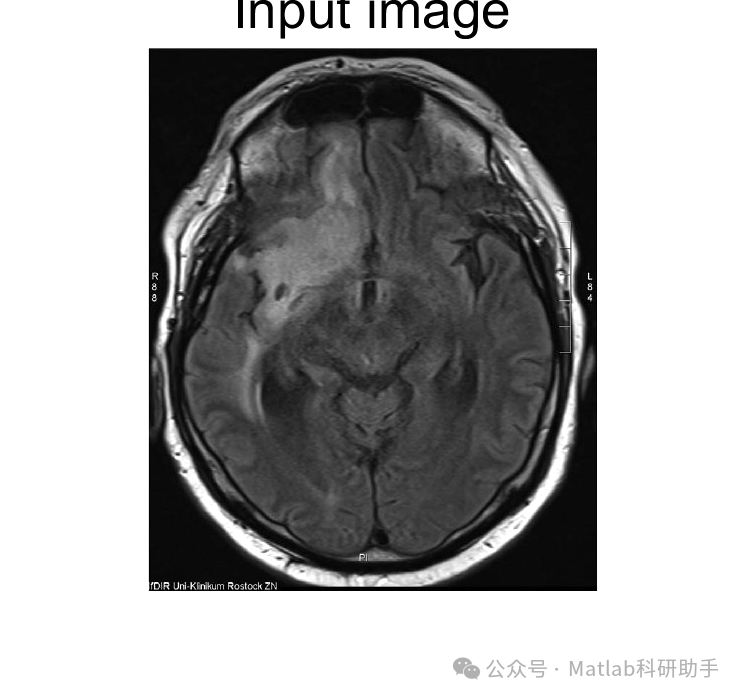 【图像分割】使用 MRI 图像进行脑肿瘤检测和分割附Matlab代码_ucsf–胶质瘤数据集分割模型-CSDN博客