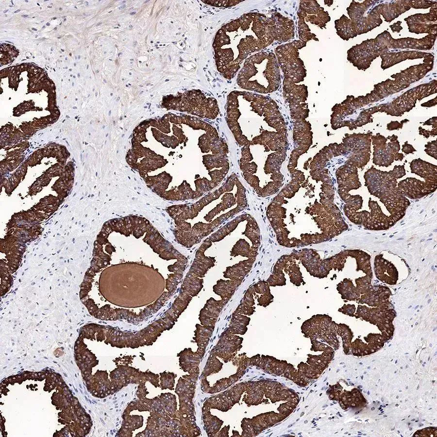 IHC肿瘤标志物 | 常见前列腺癌诊断_病理报告ihc psa-CSDN博客