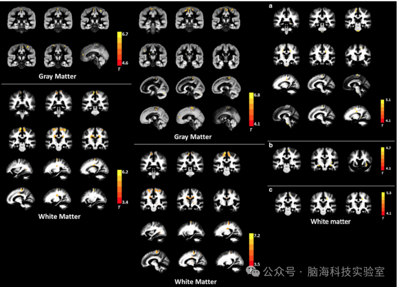 J. Magn. Reson. Imaging:来自弥散成像的退行性脑疾病的MR生物标志（研究综述）_双室张量模型-CSDN博客