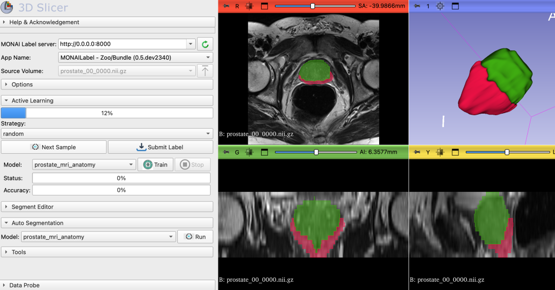 MRI前列腺分割-在3D Slicer中使用 Monai Bundle 和 Model Zoo 标注医学影像数据_3d slicer ...