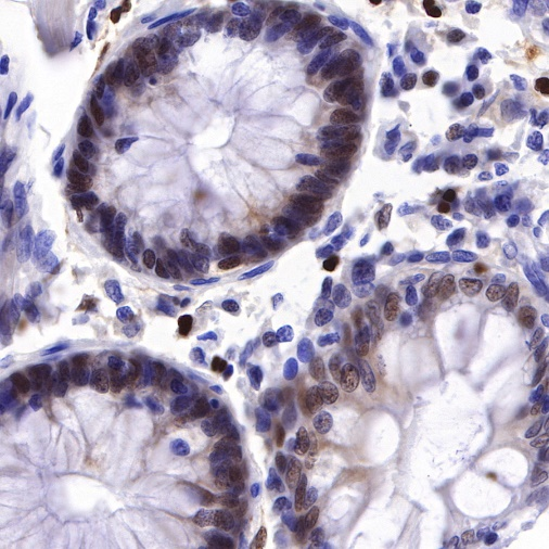 IHC Cancer Biomarker | MMR Protein Immunohistochemistry: Key Biomarker ...
