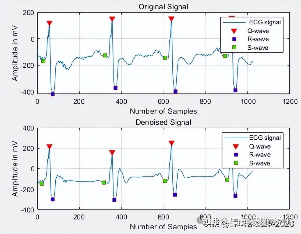 基于离散小波变换的心电信号降噪与QRS波提取（MATLAB）_基于离散小波变换的心音信号去噪算法-CSDN博客