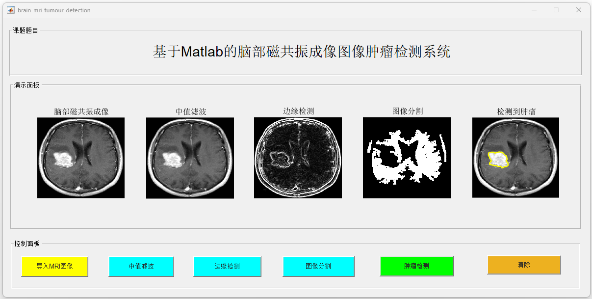 基于Matlab的脑部磁共振成像图像脑肿瘤检测系统_matlab 脑血管mri成像-CSDN博客