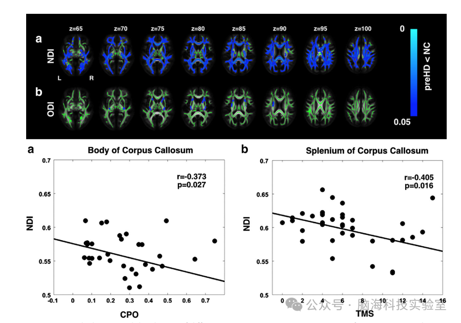 J. Magn. Reson. Imaging:来自弥散成像的退行性脑疾病的MR生物标志（研究综述）_双室张量模型-CSDN博客