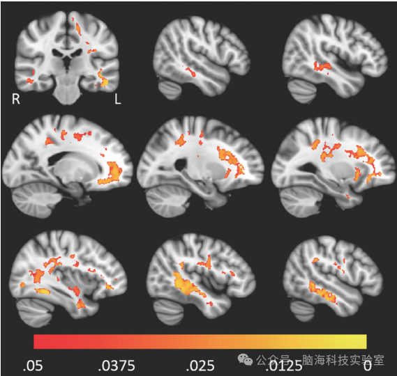 J. Magn. Reson. Imaging:来自弥散成像的退行性脑疾病的MR生物标志（研究综述）_双室张量模型-CSDN博客