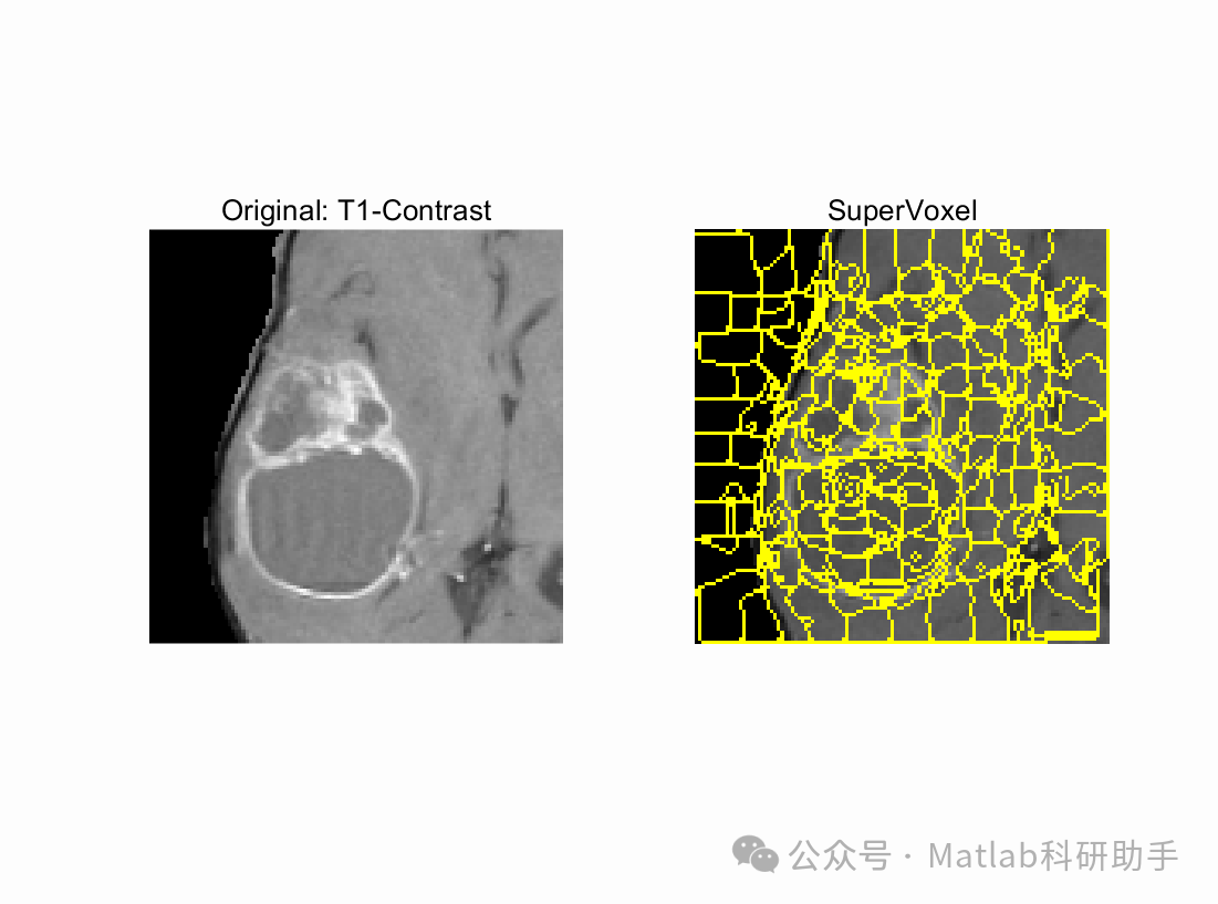 基于监督学习的多模态MRI脑肿瘤分割，使用来自超体素的纹理特征附Matlab代码-CSDN博客