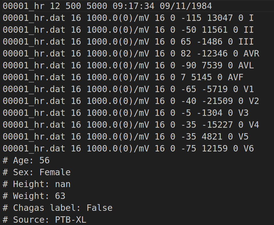 【MIMIC数据库教程】八、使用Python读取心电信号并绘制_mimic-iv-ecg-CSDN博客