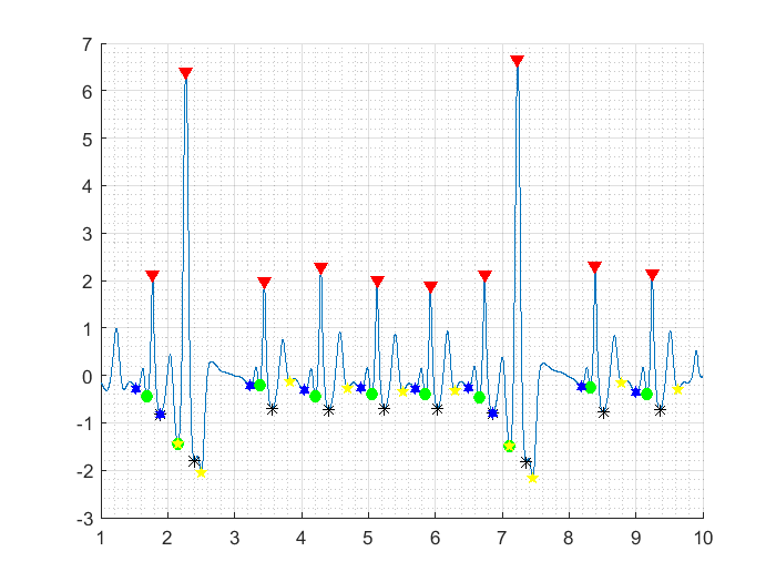 【心电信号ECG】心电图ECG心率监测器（含PR QT QRS）附Matlab代码-CSDN博客