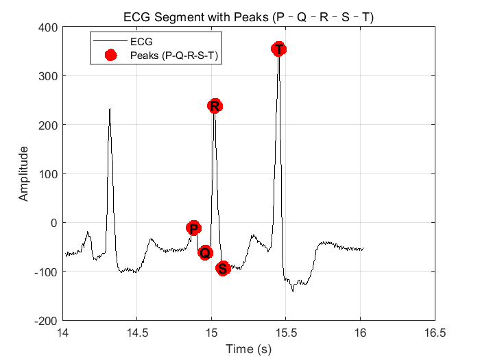【心电信号ECG】基于支持向量机SVM心电图心搏检测与分类附Matlab复现含文献-CSDN博客