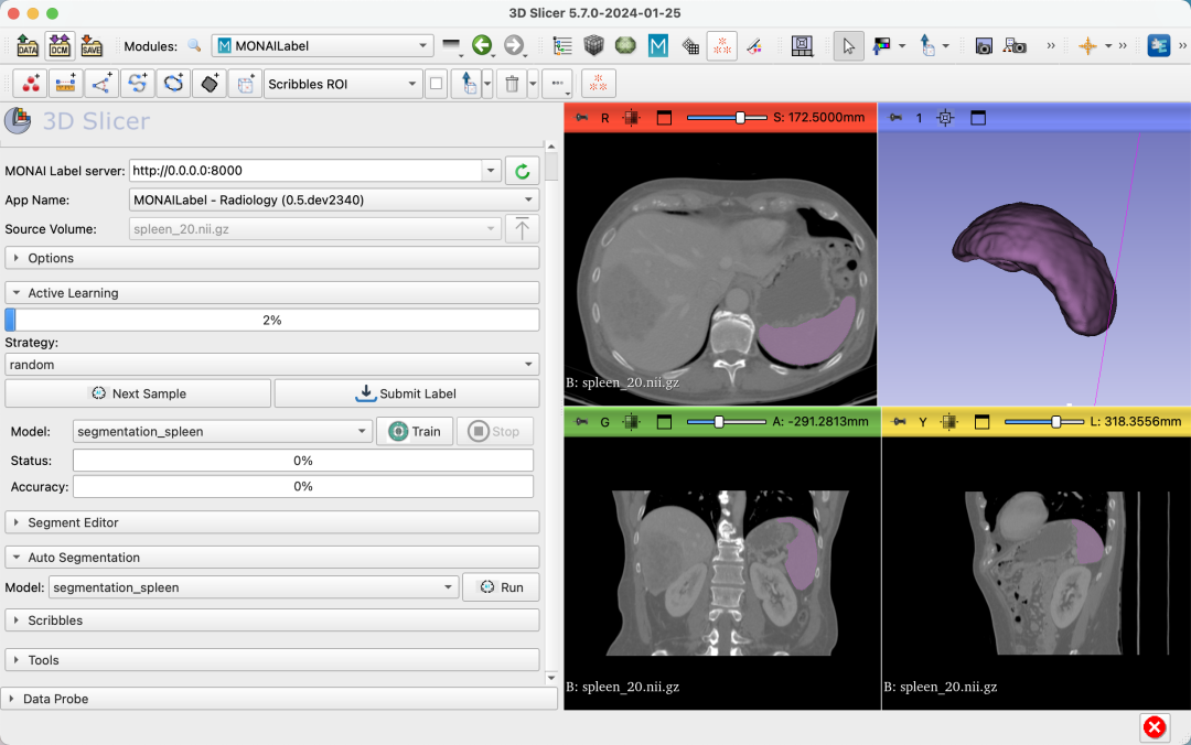MONAI Label in 3D Slicer 案例1: 在腹部CT中 自动分割脾脏_3d slicer monailabel-CSDN博客