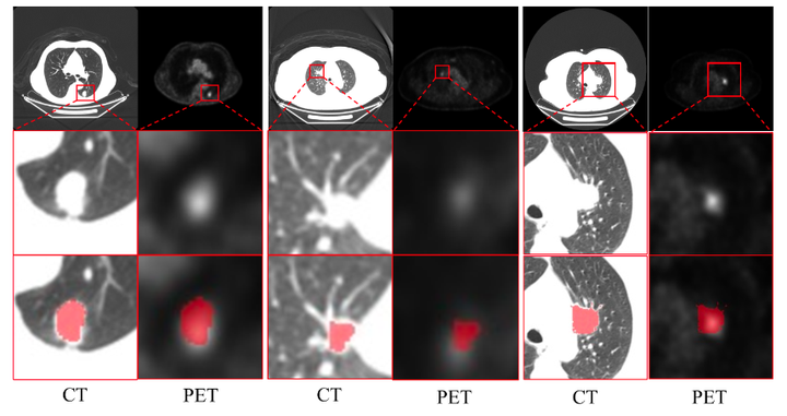 PCLT20K：首个公开的大规模PET-CT肺癌肿瘤分割数据集_肺癌数据集-CSDN博客