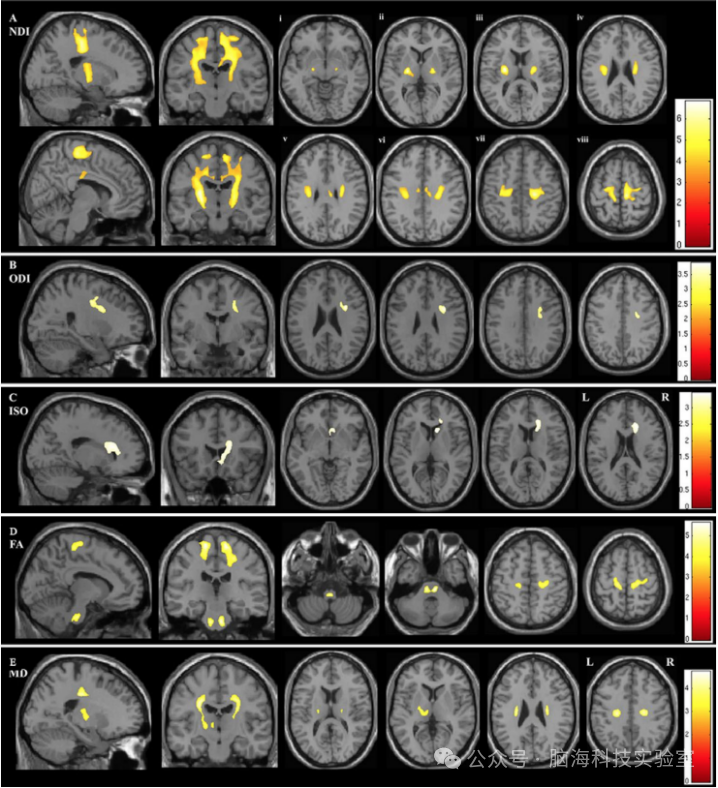 J. Magn. Reson. Imaging:来自弥散成像的退行性脑疾病的MR生物标志（研究综述）_双室张量模型-CSDN博客