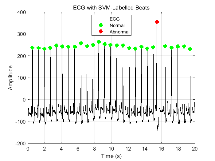 【心电信号ECG】基于支持向量机SVM心电图心搏检测与分类附Matlab复现含文献-CSDN博客