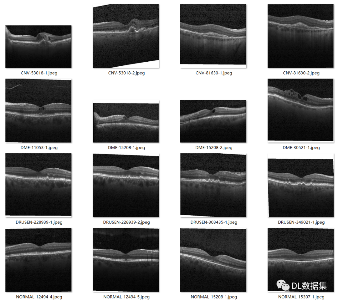 OCT2017数据集-CSDN博客