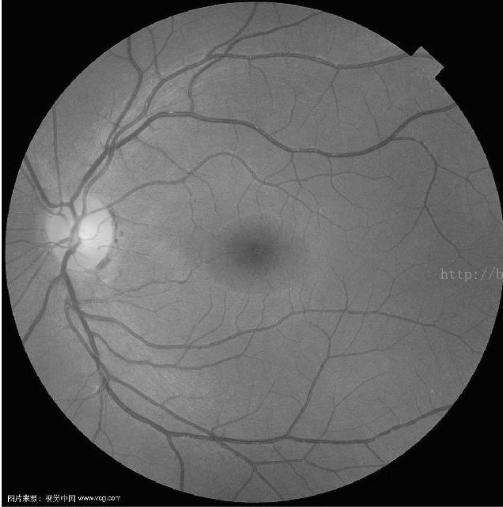 【工程应用十】 基于Hessian矩阵的Frangi滤波算法 == 血管图像增强 == Matlab中fibermetric函数的自我实现、加速和优化。-CSDN博客